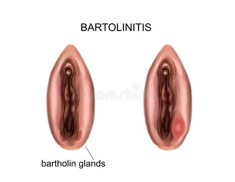 Bartholin Stock Illustrations 2 Bartholin Stock Illustrations