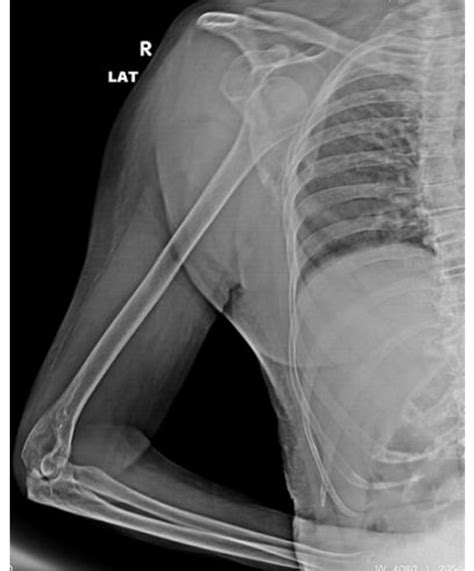 Luxatio Erecta Or Inferior Glenohumeral Joint Dislocation Download Scientific Diagram