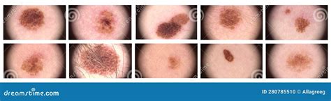 Dermatoscopy Of Skin Lesions And Moles With Dermatoscope For Preventing Skin Cancer And Melanoma