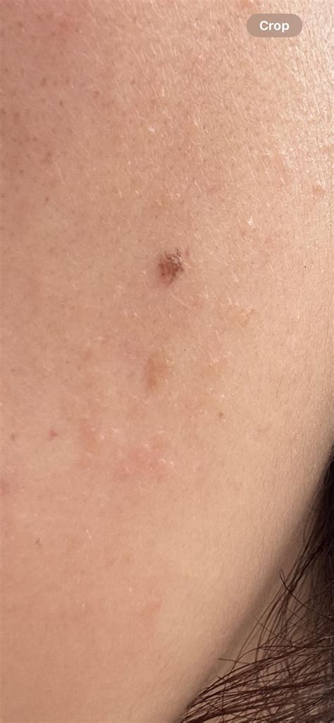 Bumpy Rash On Face Rdermatologyquestions