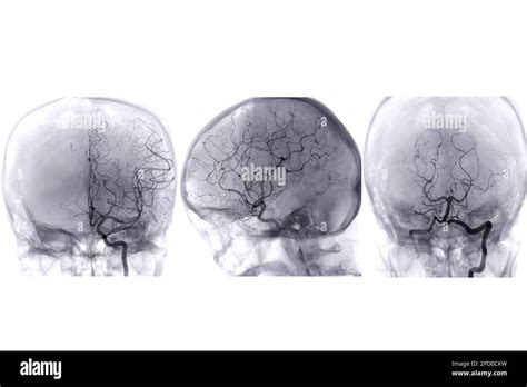 Cerebral Angiography Image From Fluoroscopy In Intervention Radiology