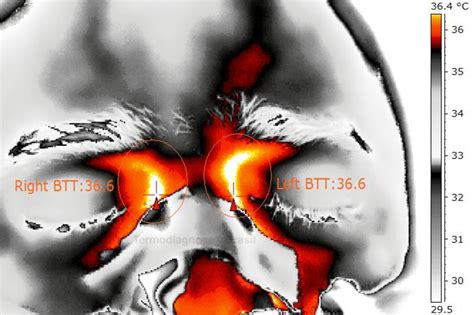 Thermal Image Of The Face Of A Patient In Confirmed Brain Death
