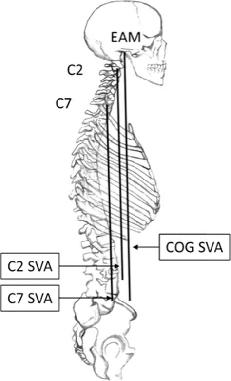 Relationship Of Cervical Sagittal Vertical Alignment After Sagittal