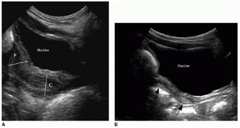 The Female Pediatric Pelvis Radiology Key