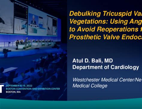 Tct 694 Debulking Tricuspid Valve Vegetations Using Angiovac To Avoid