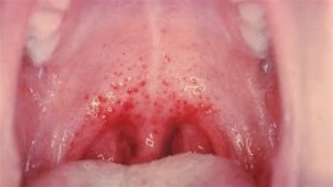 Faringitis Akut Penyebab Gejala Tanda Tanda Dan Pencegahan Indotimes