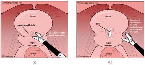 Vesicovaginal Fistulas Prevalence Impact And Management Challenges Pmc