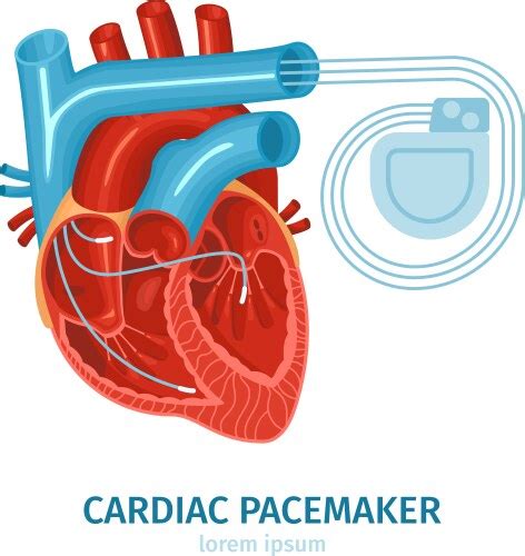 Herz Icon Pacemaker Vector Images über 720