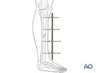 Treatment Of Simple Oblique Fracture