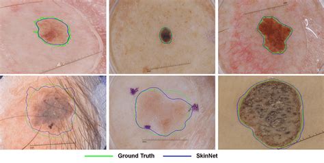 Skinnet Segmentation Output On Isbi 2017 Test Dataset The Green