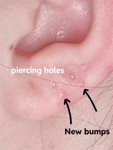 Pimple Like Bumps Have Appeared Next To My Old Lobe Piercing Sites