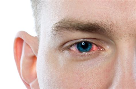 40 Facts About Gonococcal Conjunctivitis