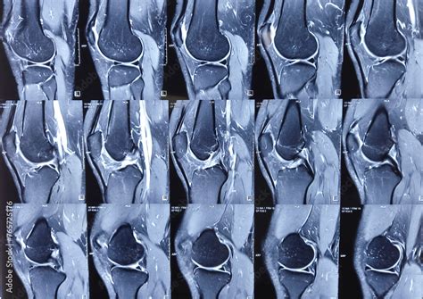 Mri Knee Joint Osteosarcoma Soft Tissue Such As Muscle Ligaments And