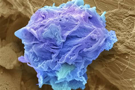 Pronostic Et Traitement Du Lymphome Lymphoblastique