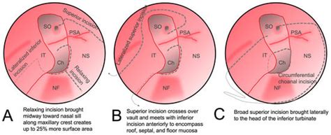 Reconstruction Of The Anterior Skull Base Using The Nasoseptal Flap A