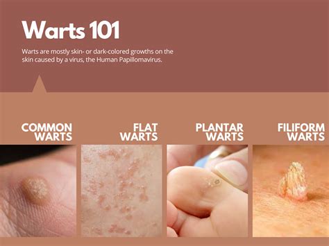 Can Skin Tags Be Mistaken For Genital Warts Kjdnpr