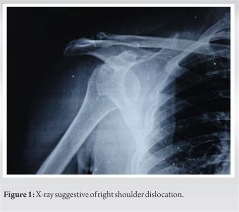 Recurrent Anterior Shoulder Dislocation With Coracoid Fracture In An Old Age Male A Rare Case