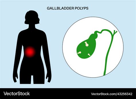 Gallbladder Polyp Anatomy Royalty Free Vector Image