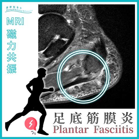 Magnetic Resonance Imaging Mri Plantar Fasciitis 聖德肋撒醫院 掃描部 St