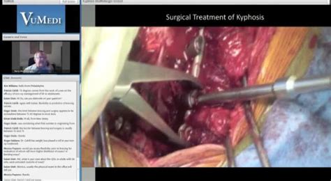 Kyphosis Surgery