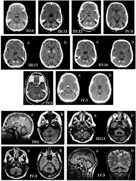 Neuroradiology Top Three Rows Non Contrast Axial Brain Ct Scans On