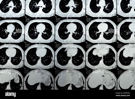 Multi Slice Ct Scan Of The Chest Showing Normal Study Normal