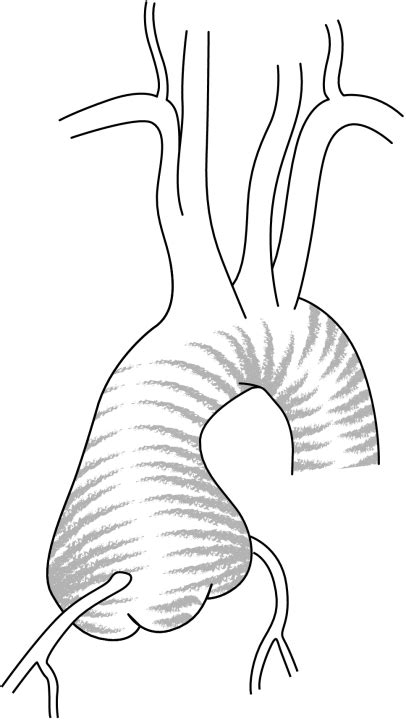Dilation Of The Thoracic Aorta Medical And Surgical Management Pmc