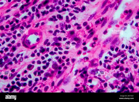 Hodgkins Lymphoma Light Micrograph Photo Under Microscope High