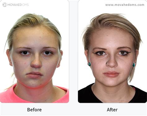 Asymmetric Jaws Surgery Jaw Surgery Questions Asymmetry R