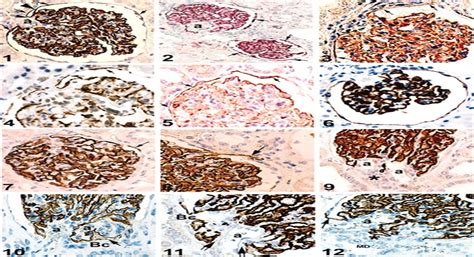 Parietal Podocytes In Normal Human Glomeruli Journal Of The American