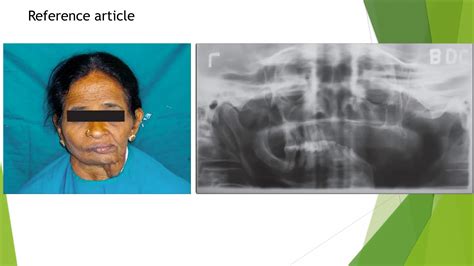 Double Occlusal Prosthesis Jcpptx Presentation Pptx