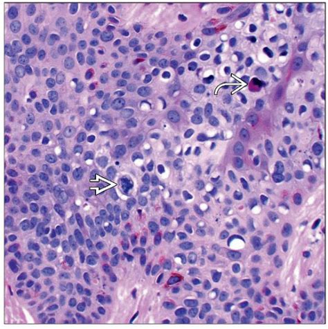 Squamous Cell Carcinoma In Situ Bowen Disease Basicmedical Key