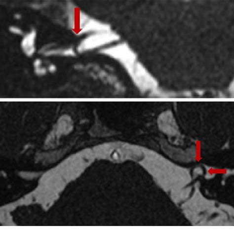 Examples Of Type Ii Vascular Loop Of Aica And Cn Viiviii Complex Aica