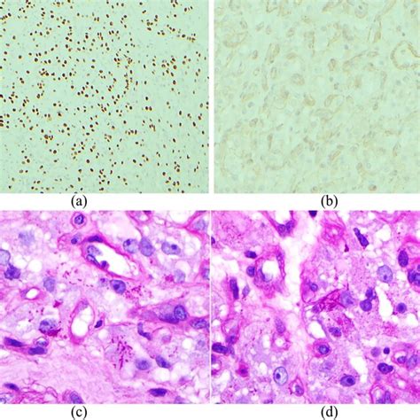 Pelvic Doppler Us Echogenic Mass Within The Lower Uterine Segment