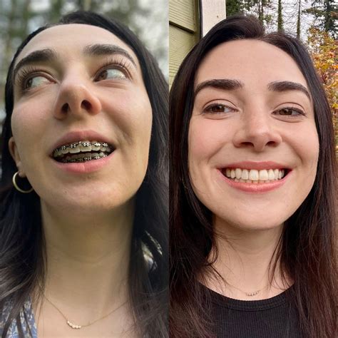 Update Upper Bleph 6 Weeks Post Op 42f Thin Stretchy Skin R