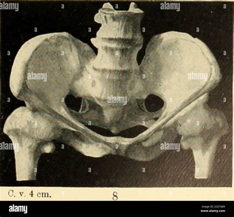 Rachitic Pelvis