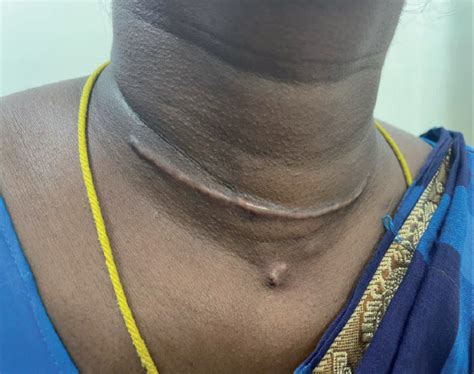 To Drain Or Not To Drain Following Thyroidectomy A Prospective