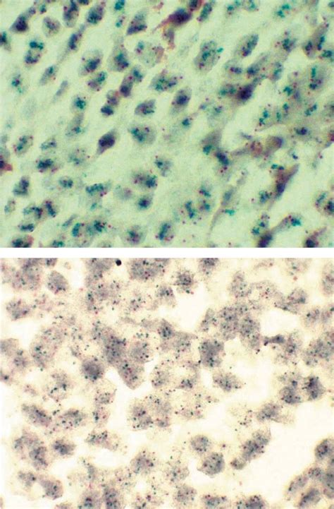 Illustration Of A Cish Result Performed On The Patient Tumor Sample A Download Scientific