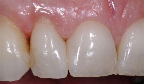 A Modern Day And Predictable Approach To Gingival Embrasures Optident