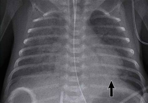 Course Xray Classifier Classification Dataset And Pre Trained Model By Pooja Course Workspace
