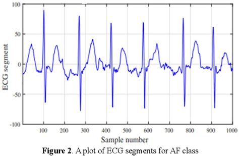 Figure 2 From Computer Aided Detection Of Atrial Fibrillation Episodes From Electrocardiogram