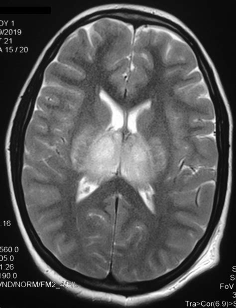 Dengue Encephalitis And ‘double Doughnut Sign Bmj Case Reports