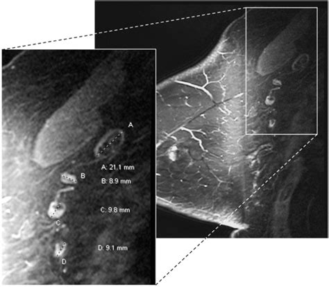 Swollen Lymph Nodes Armpit Ultrasound