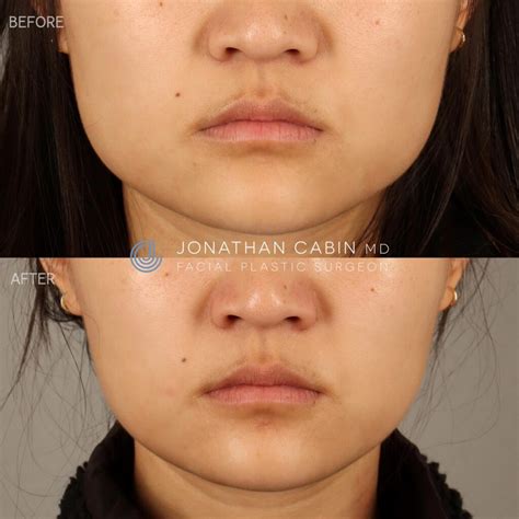 Facial Slimming Procedures Before And Afters Dr Jonathan Cabin