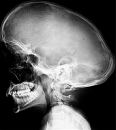 Skull Deformity Buyxraysonline