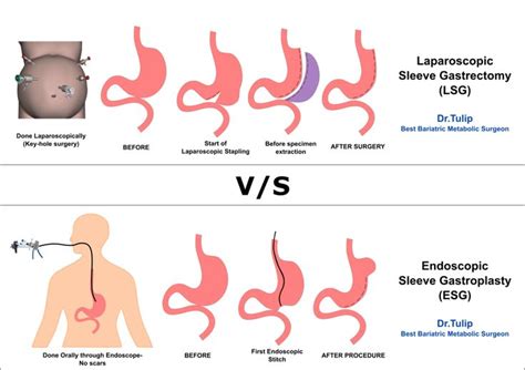 Sleeve Gastrectomy Vs Endoscopic Sleeve Gastroplasty Which Is Right