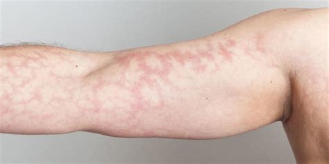 5 Mottled Skin Causes And Treatment Options