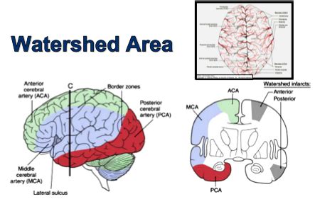 Stroke Flashcards Quizlet