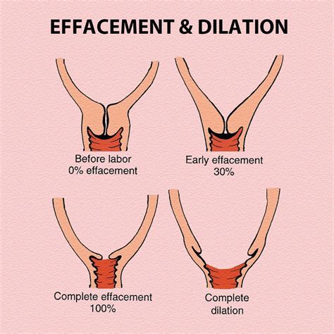 Pregnancy 👶 Effacement And Dilation What They Mean 📏 Effacement