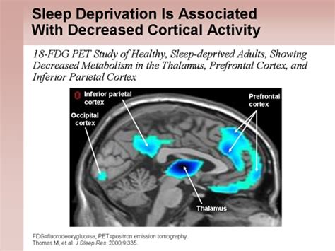 Recognizing And Managing Insomnia And Comorbid Conditions Slides With Transcript